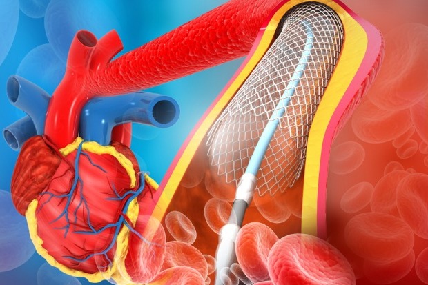 Studypages - ILUMIEN IV: A Study of OPtical Coherence Tomography (OCT ...