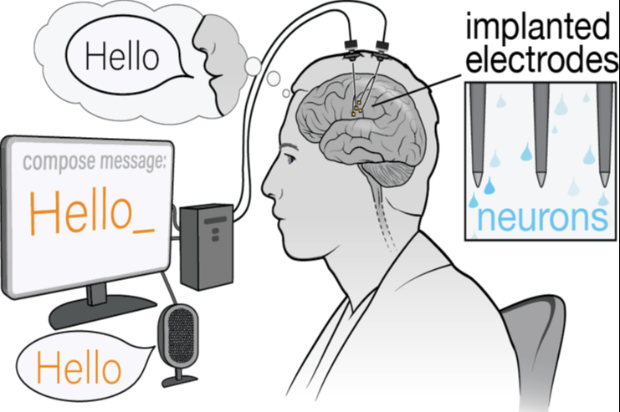 Studypages - BrainGate2: Feasibility Study of an Intracortical Neural ...